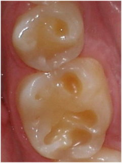 Acid Erosion - Elmbrook Family Dental